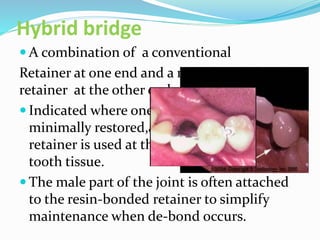 Resin bonded fixed partial denture | PPTX