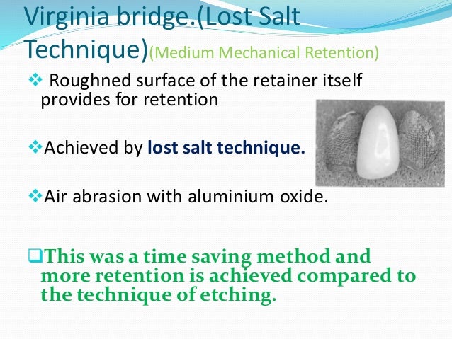 Resin bonded fixed partial denture