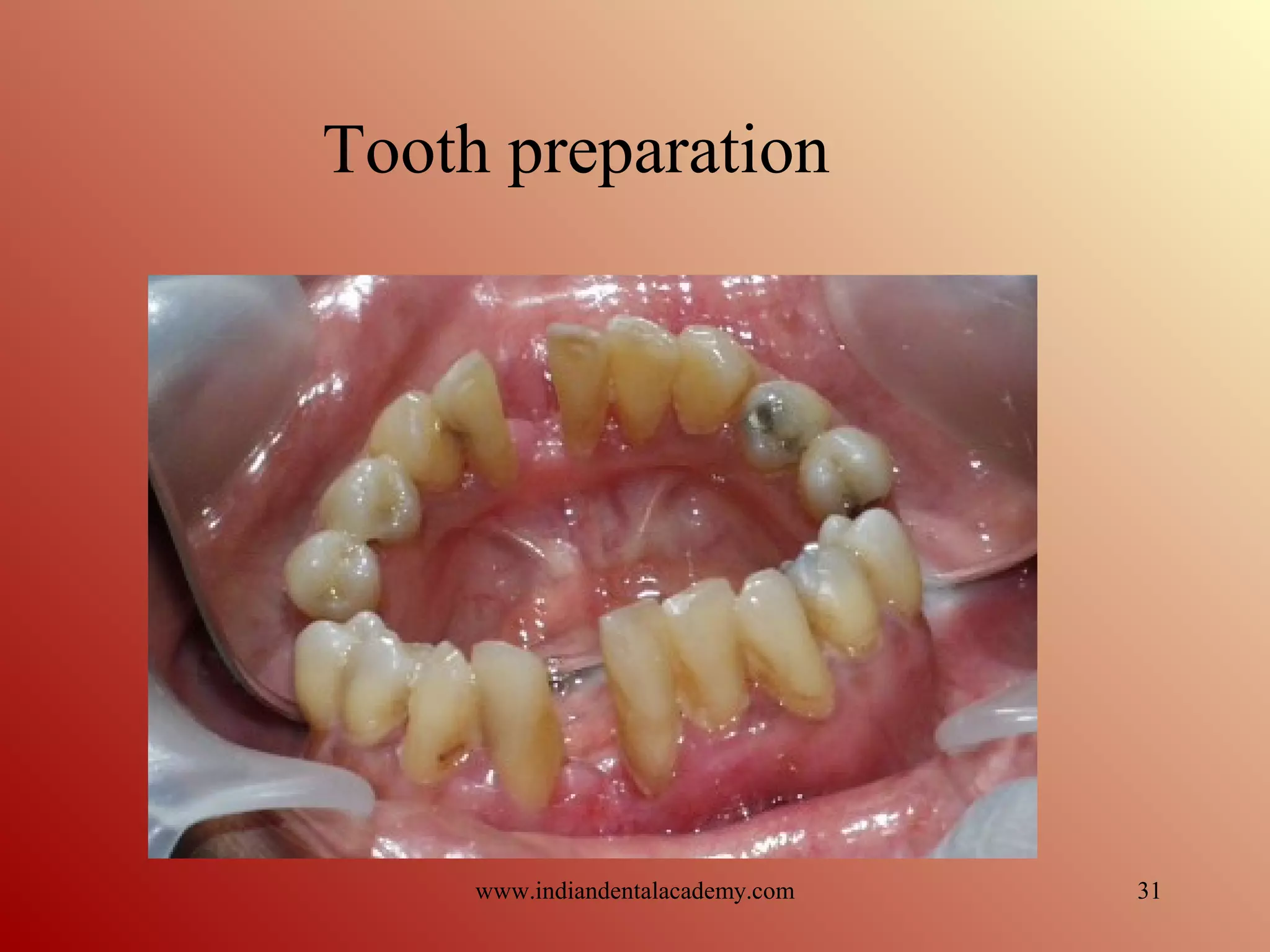 Resin bonded bridges.modi/ Labial orthodontics | PPT | Oral care ...