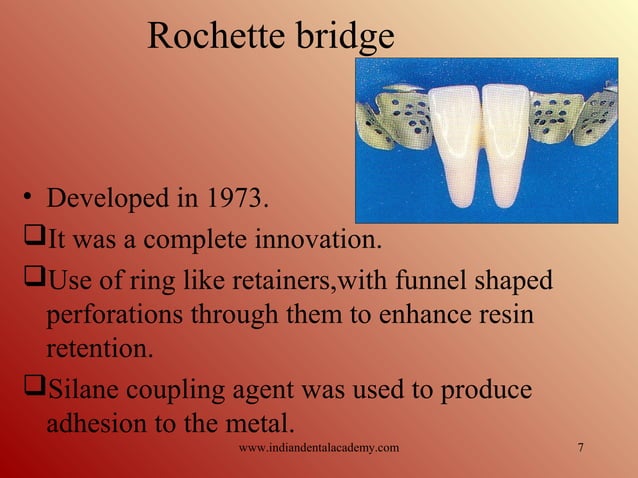 Resin bonded bridges.modi/ Labial orthodontics | PPT