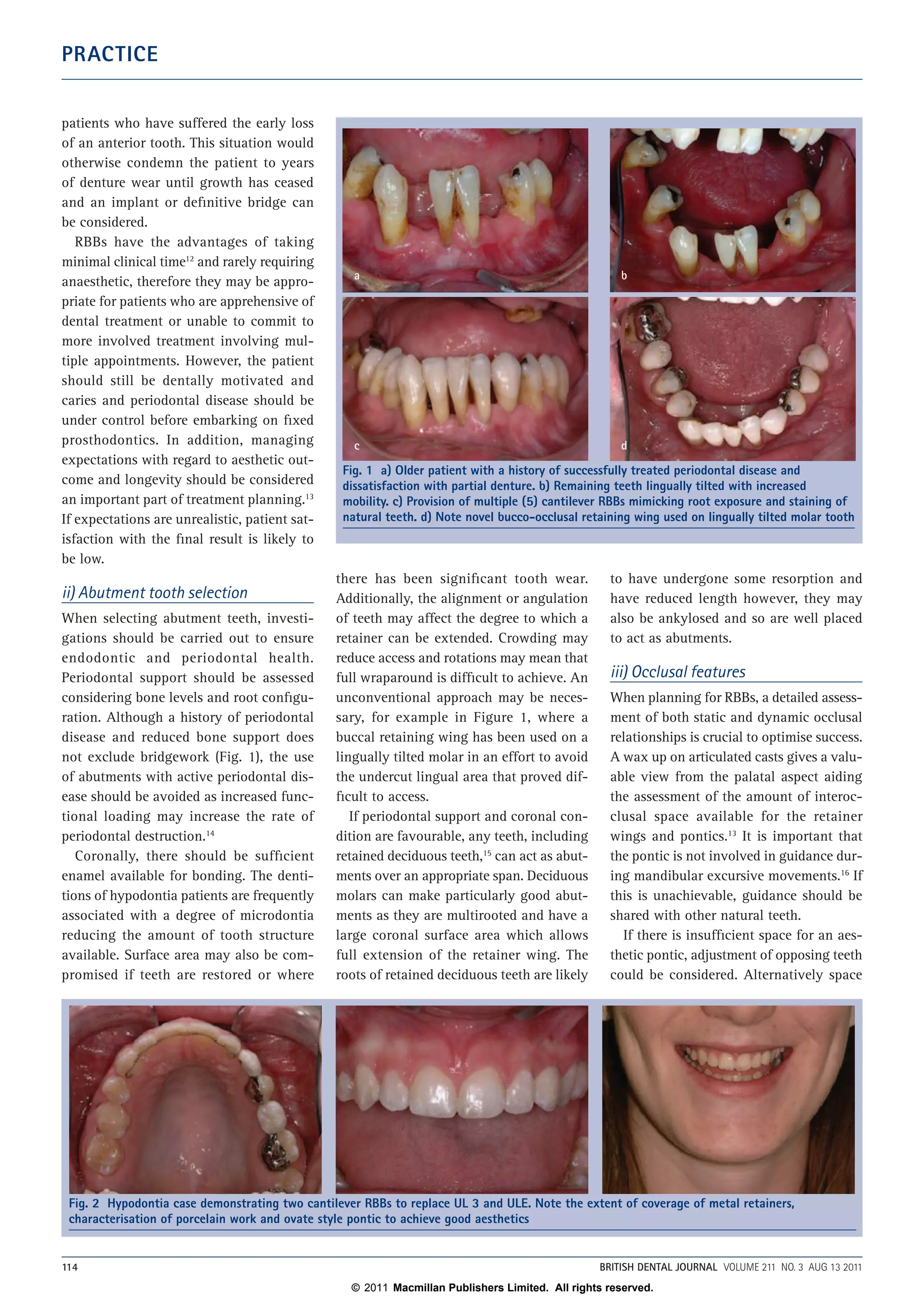 Resin bonded bridges | PDF