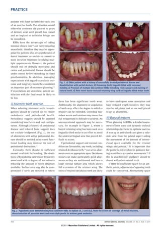 Resin bonded bridges | PDF