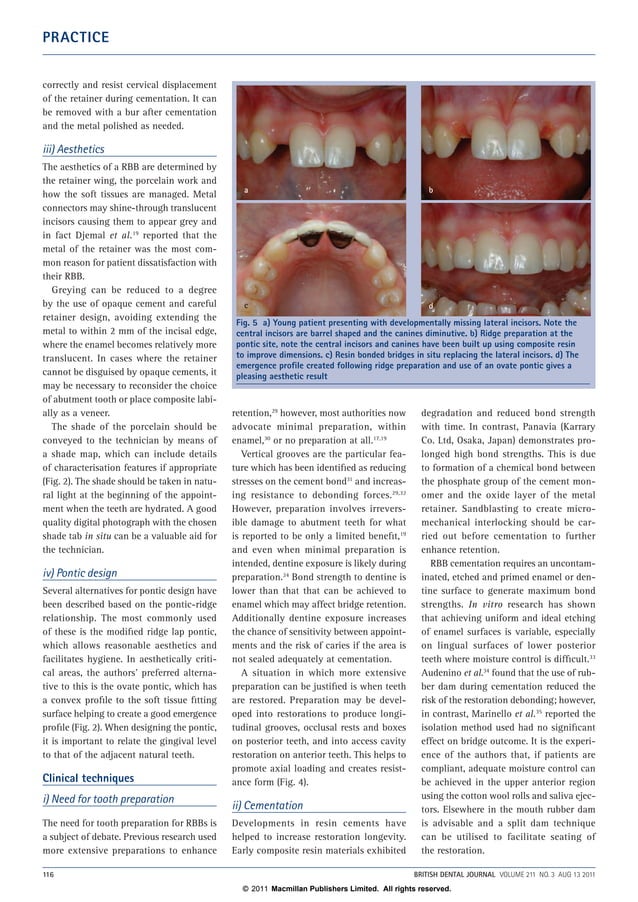 Resin bonded bridges | PDF | Dental Health | Diseases and Conditions
