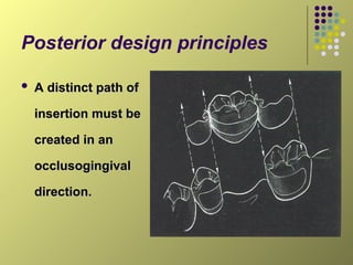 Resin Bonded Bridges mary land bridge.ppt