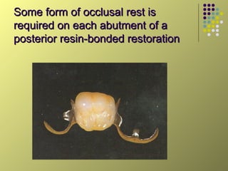 Resin Bonded Bridges mary land bridge.ppt