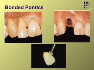 Resin Bonded Bridges mary land bridge.ppt