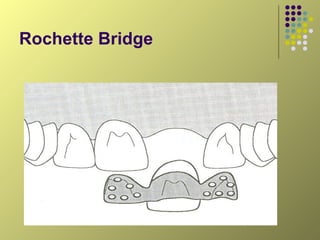 Resin Bonded Bridges mary land bridge.ppt