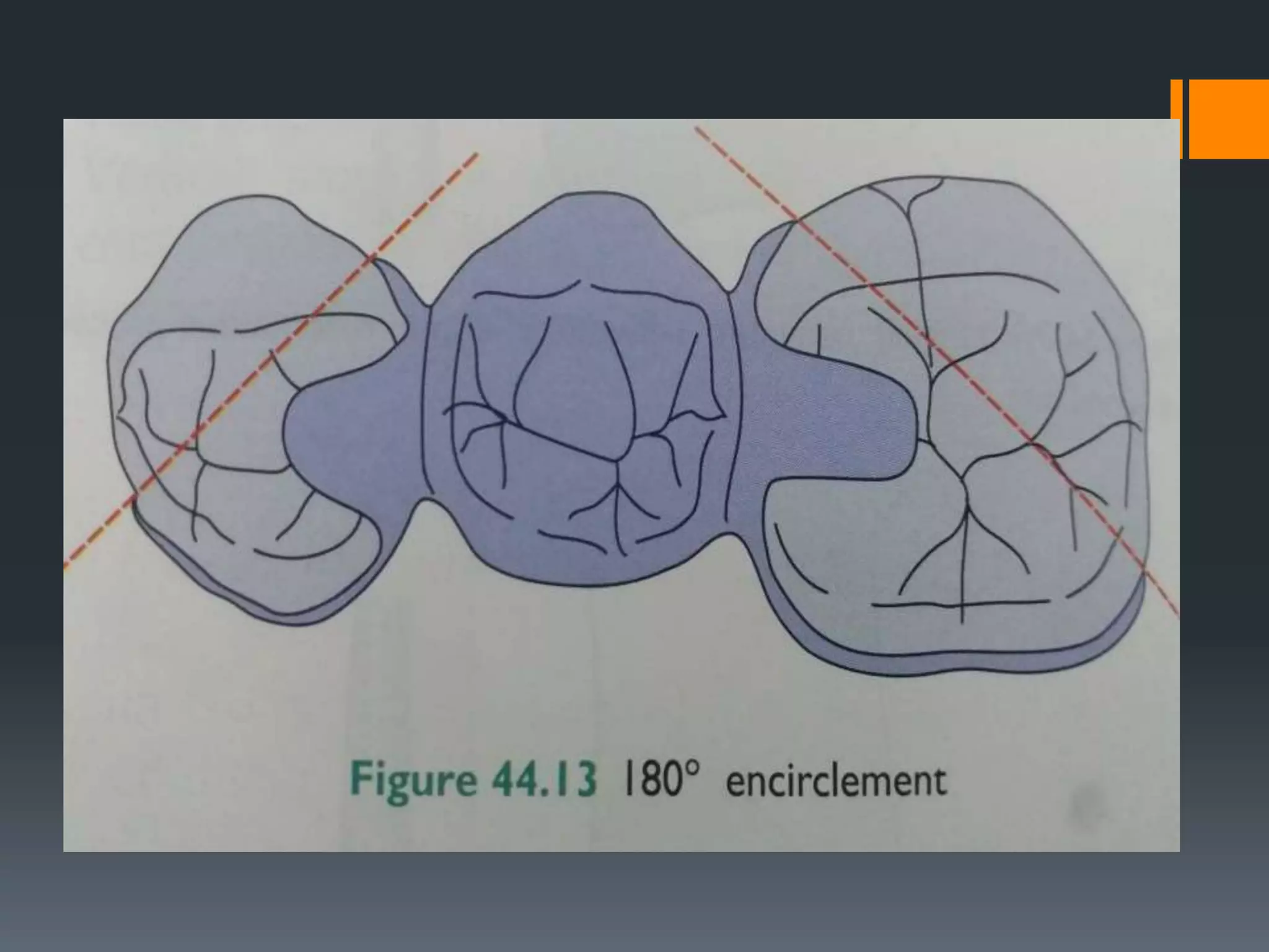 RESIN BONDED FPD.pptx