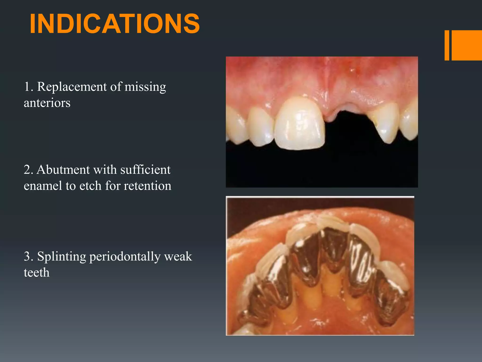 RESIN BONDED FPD.pptx