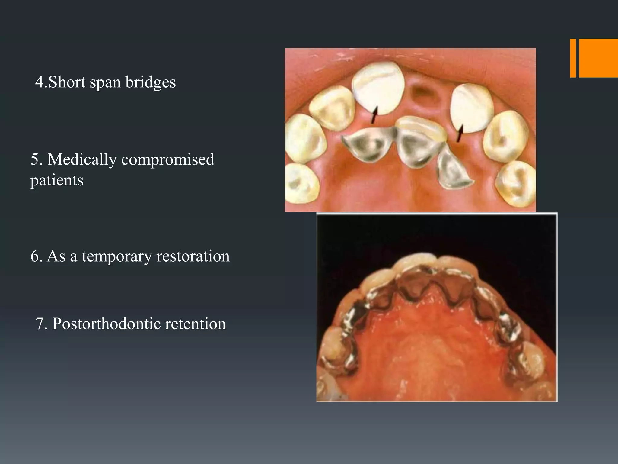 RESIN BONDED FPD.pptx