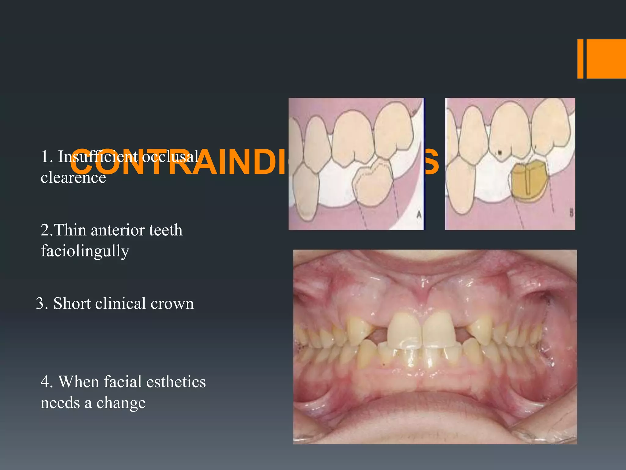RESIN BONDED FPD.pptx