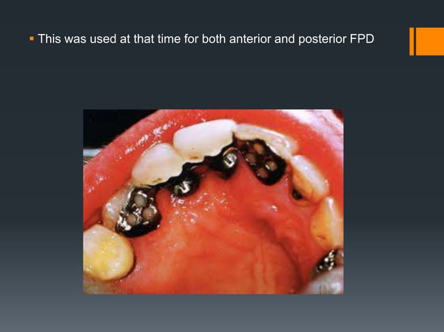 RESIN BONDED FPD.pptx