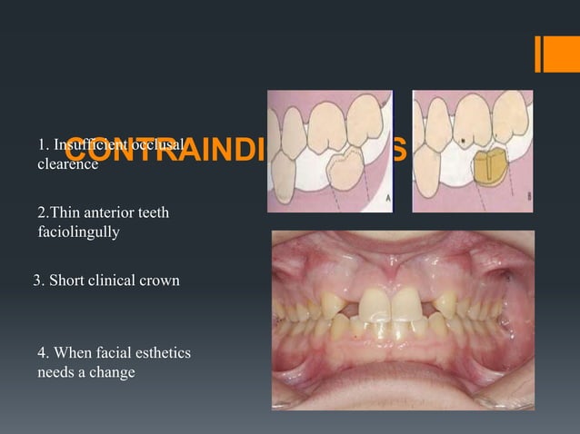 RESIN BONDED FPD.pptx