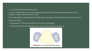 Resin Bonded fpd.pdf