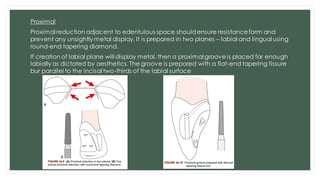 Resin Bonded fpd.pdf