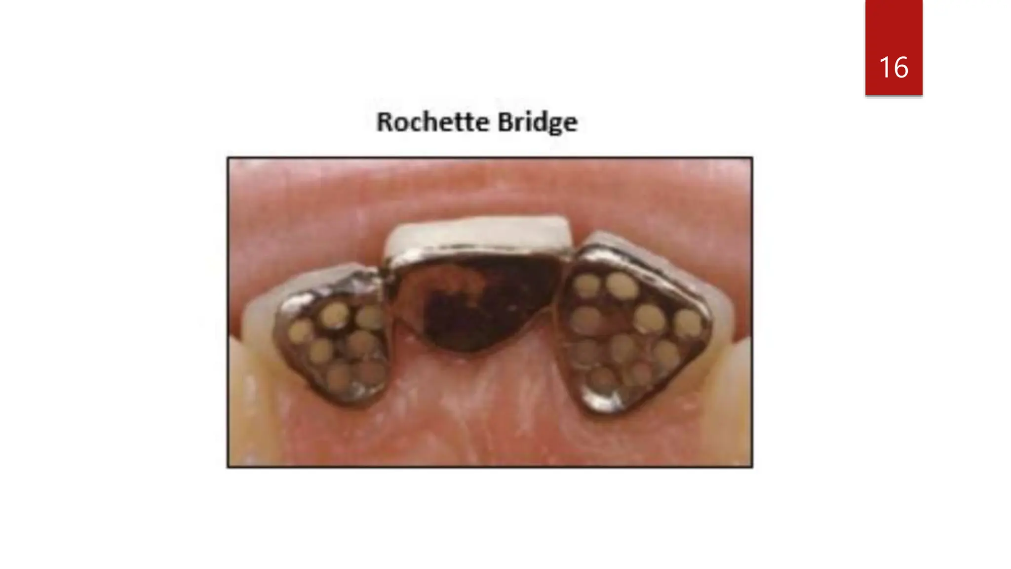 Resin bonded fixed partial denture. (RBFPD'S) | PPTX