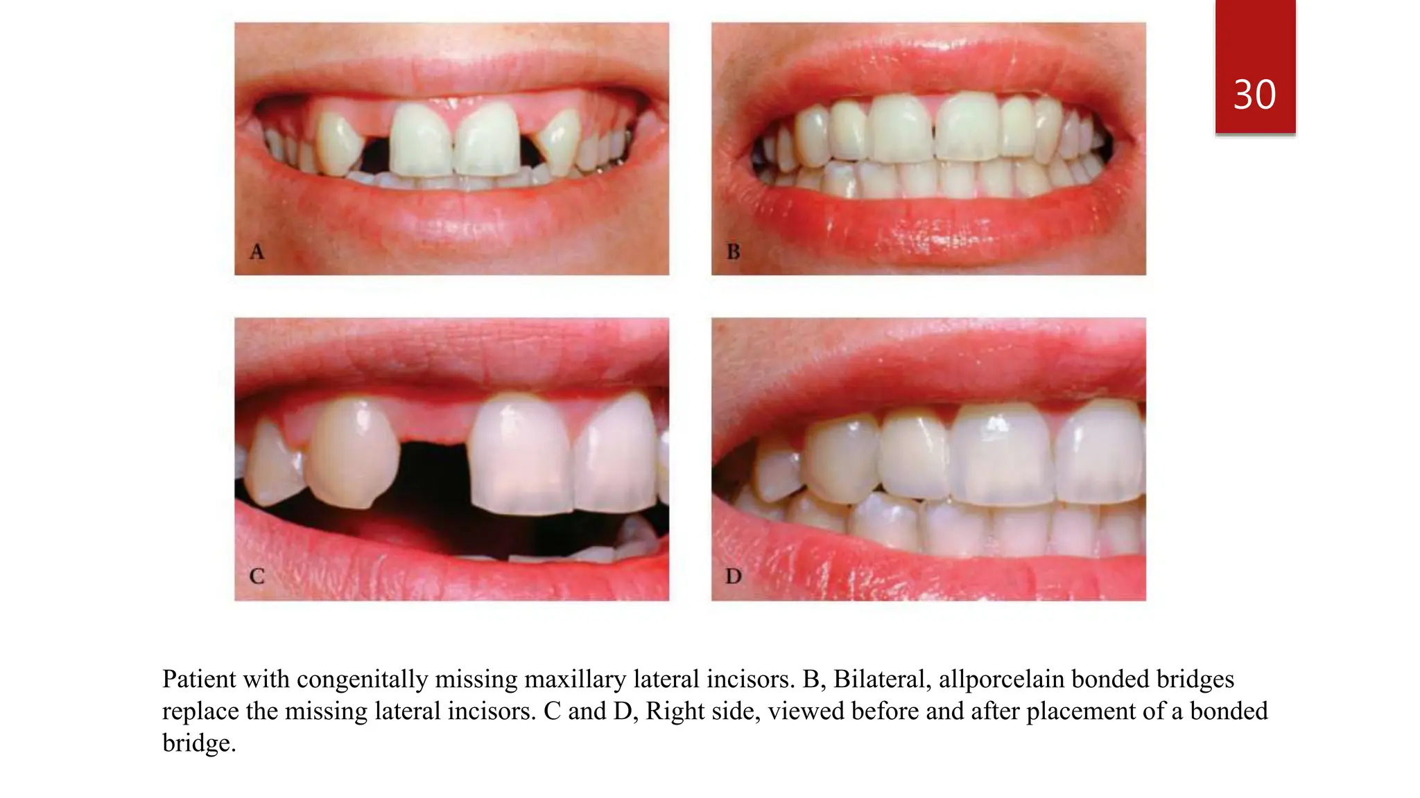 Resin bonded fixed partial denture. (RBFPD'S) | PPTX