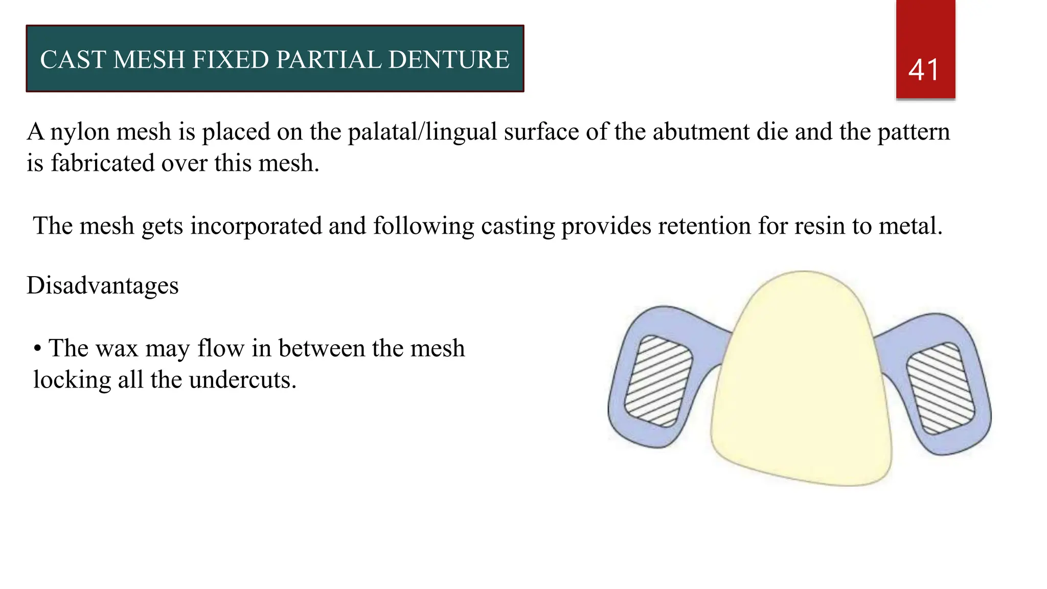 Resin bonded fixed partial denture. (RBFPD'S) | PPTX