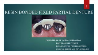 Resin bonded fixed partial denture. (RBFPD'S) | PPTX