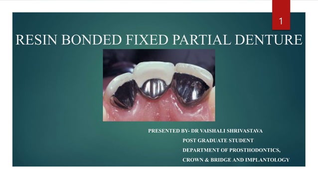 Resin bonded fixed partial denture. (RBFPD'S) | PPTX