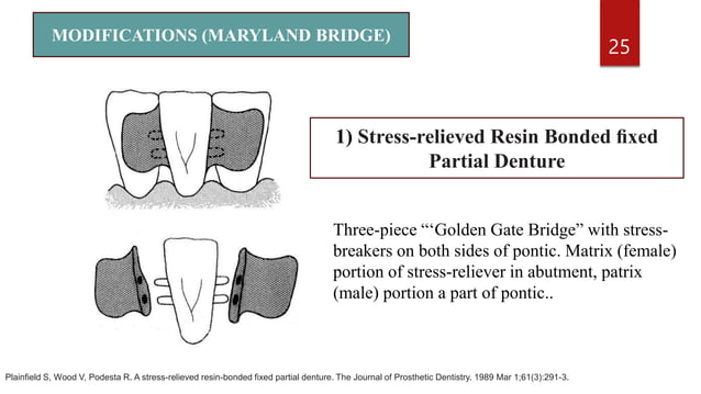 Resin bonded fixed partial denture. (RBFPD'S) | PPTX