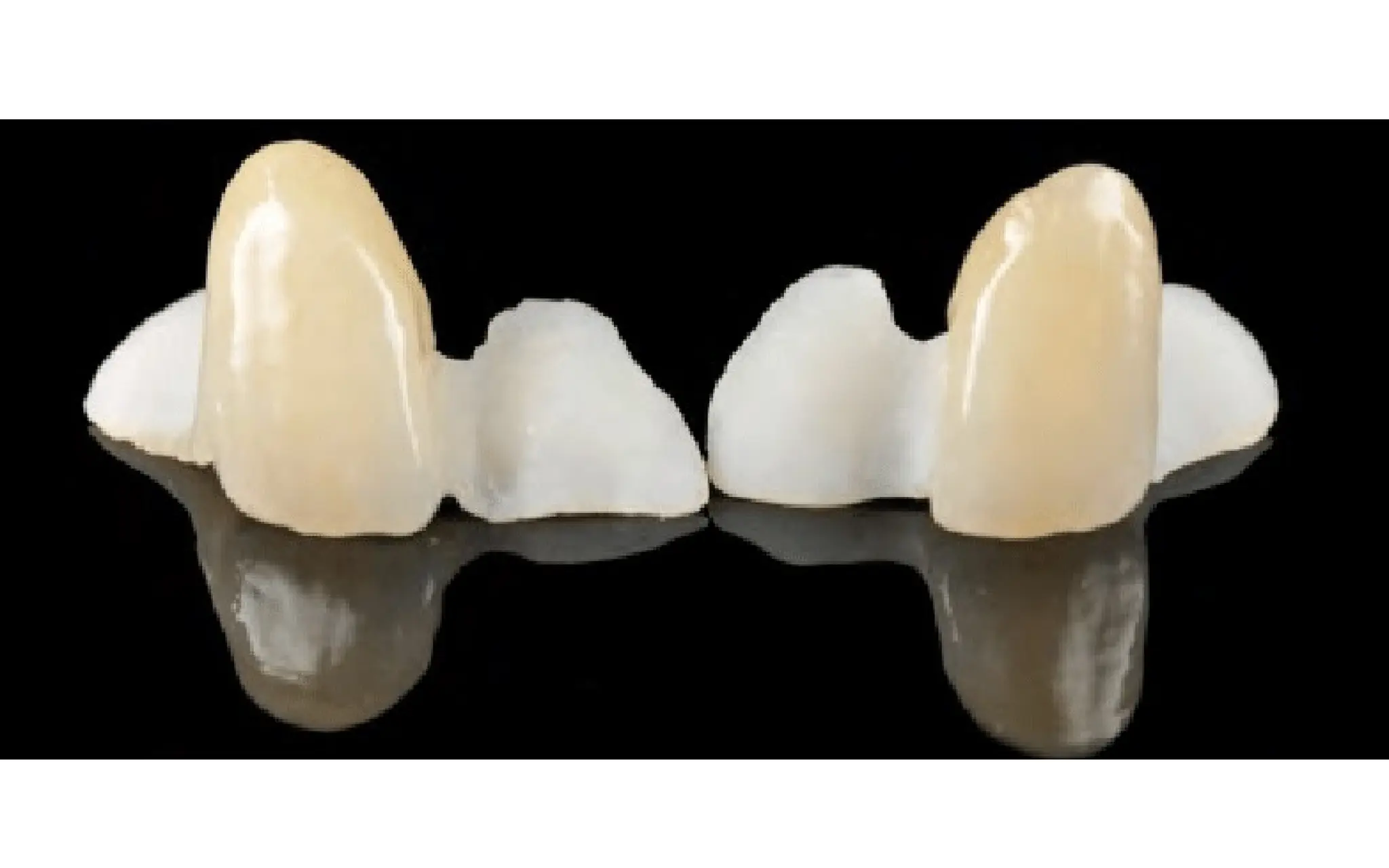 Resin bonded Fixed partial denture - treatment option | PPTX