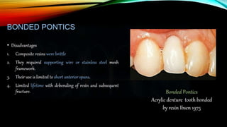 Anterior Resin bonded FPD | PPT
