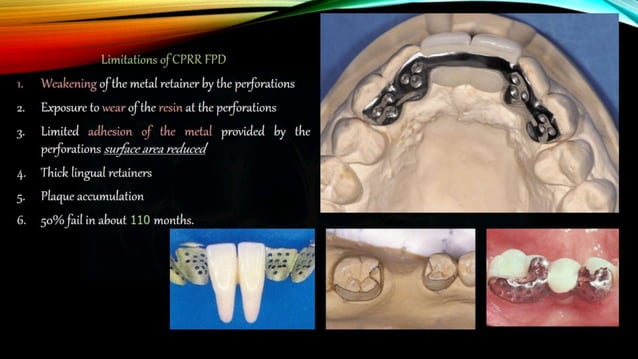 Anterior Resin bonded FPD | PPT