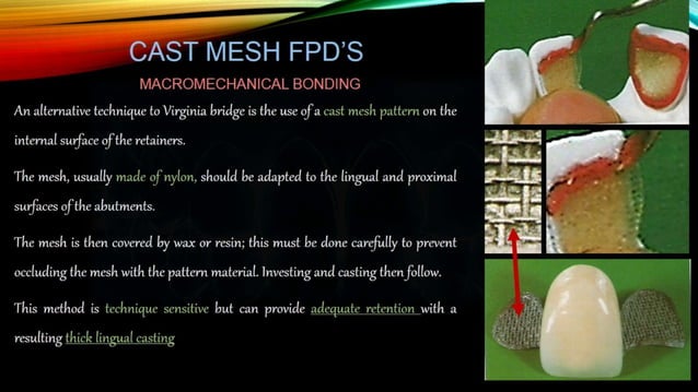 Anterior Resin bonded FPD | PPT