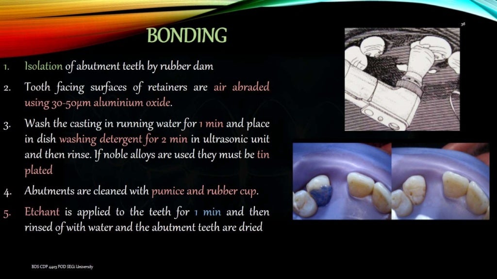 Anterior Resin bonded FPD