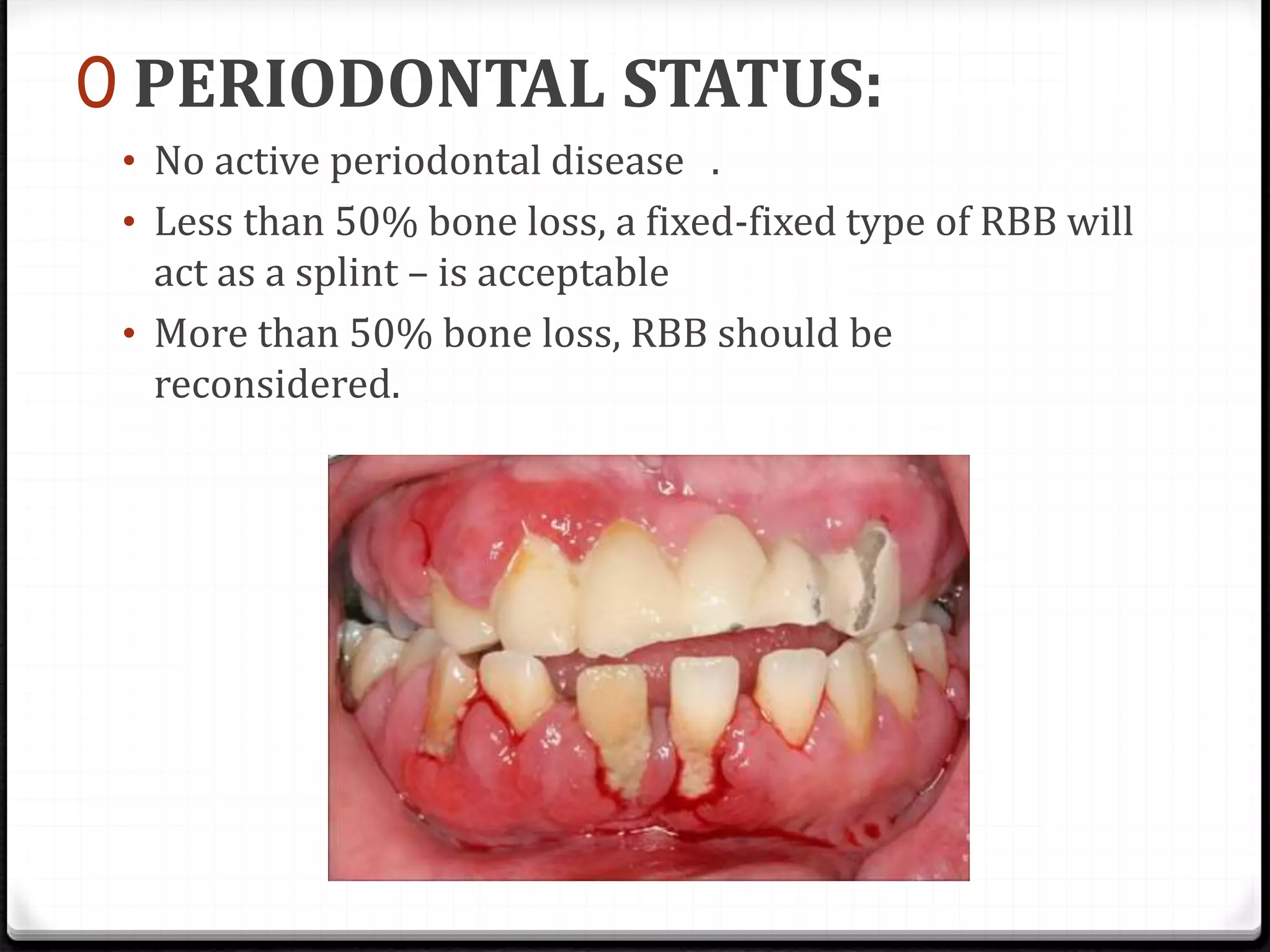 Resin Bonded Bridges | PPTX