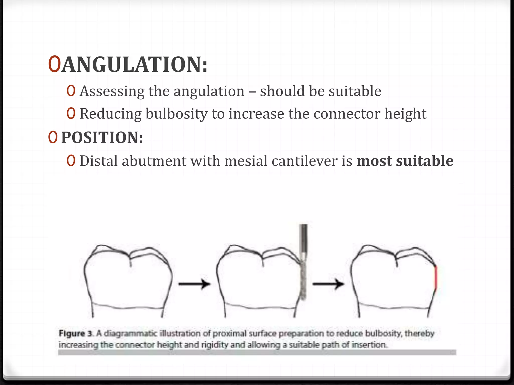 Resin Bonded Bridges | PPTX