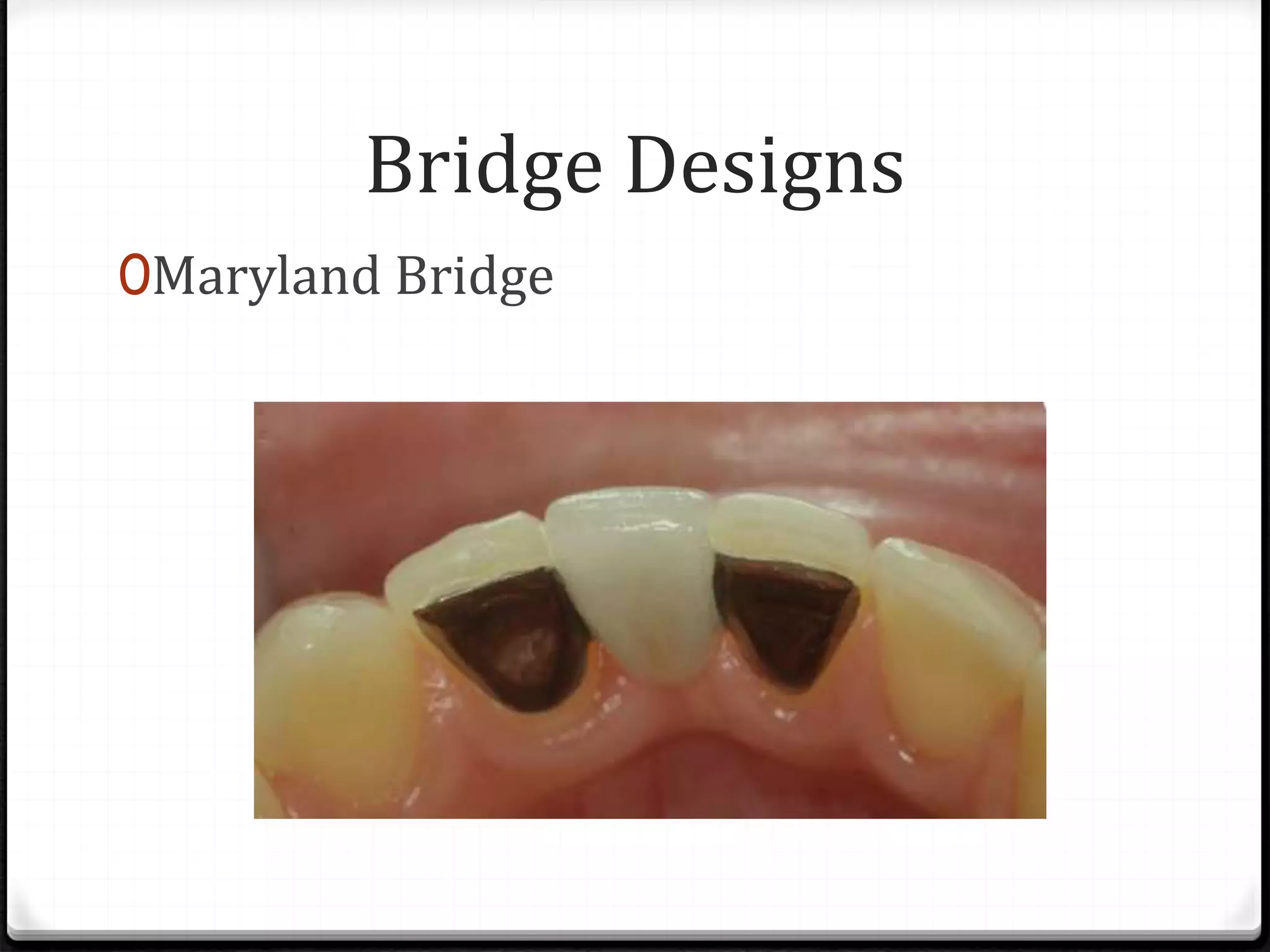 Resin Bonded Bridges | PPTX
