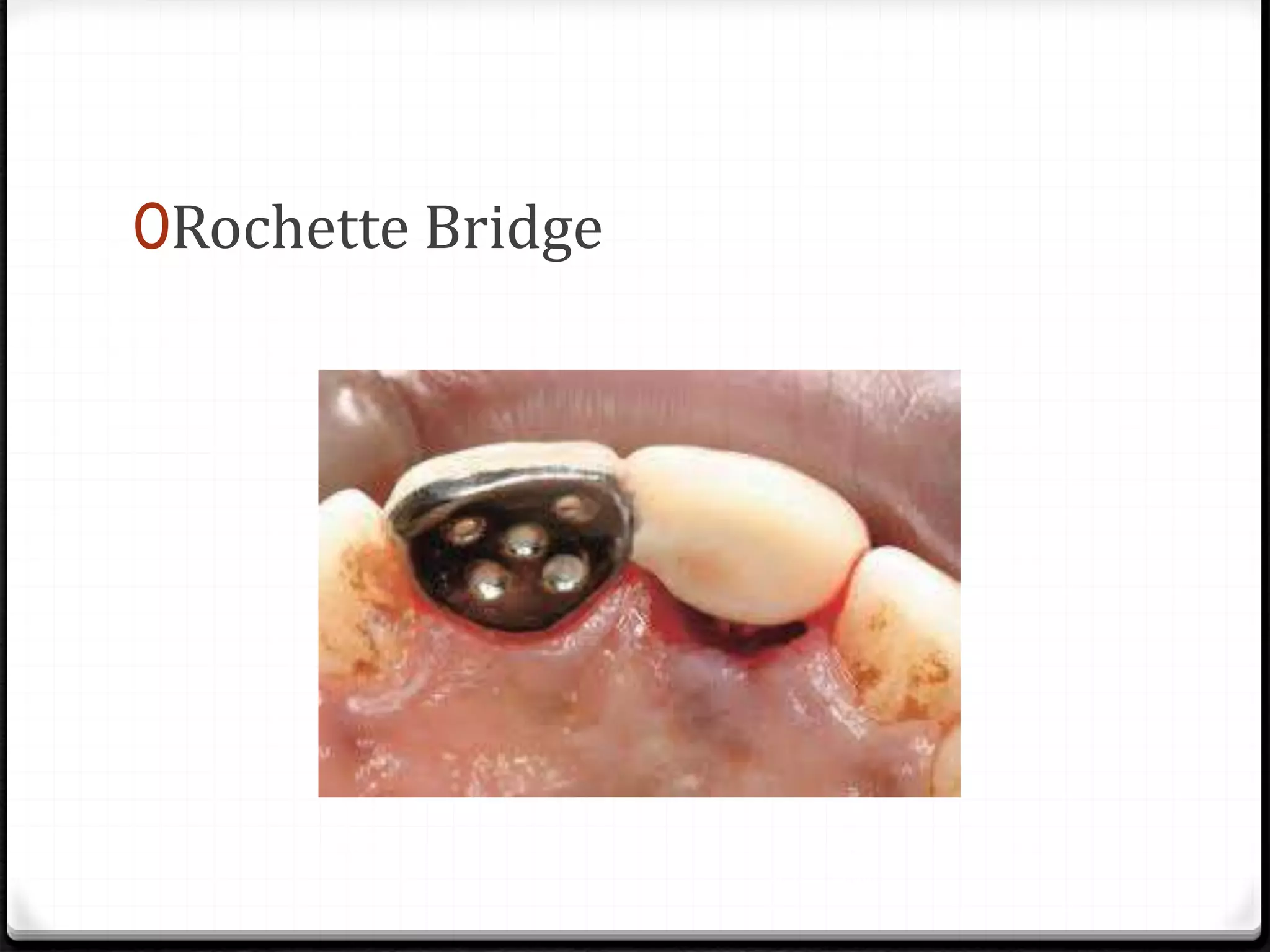 Resin Bonded Bridges | PPTX