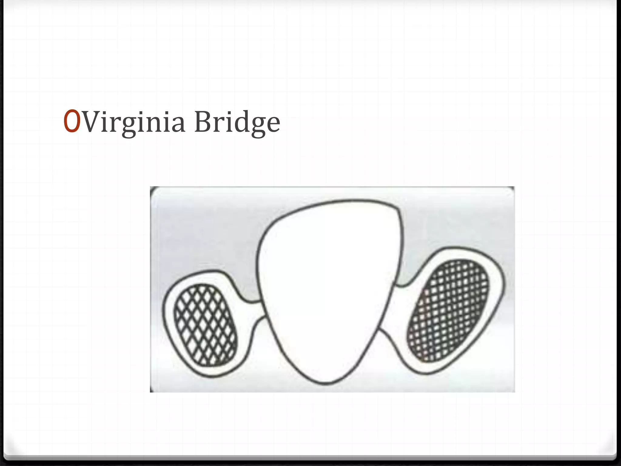 Resin Bonded Bridges | PPTX