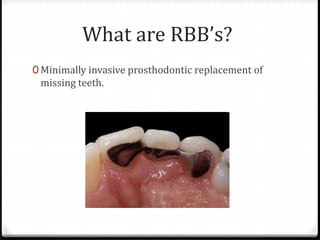 Resin Bonded Bridges | PPTX