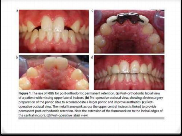 Resin Bonded Bridges | PPTX | Dental Health | Diseases and Conditions
