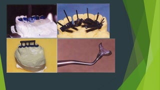 Resin bonding FOR MAXILLOFACIAL PROSTHESES.pptx