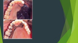 Resin bonding FOR MAXILLOFACIAL PROSTHESES.pptx