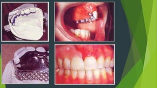 Resin bonding FOR MAXILLOFACIAL PROSTHESES.pptx