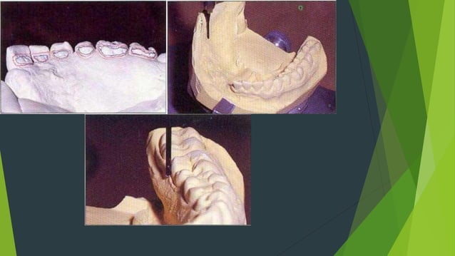 Resin bonding FOR MAXILLOFACIAL PROSTHESES.pptx