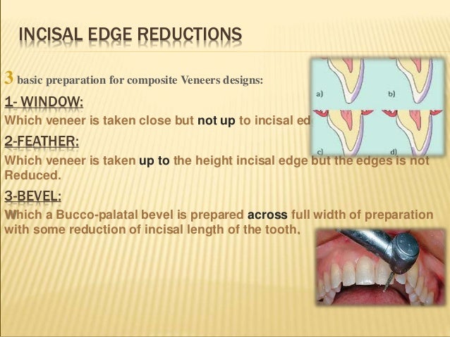 Resin laminate veneers