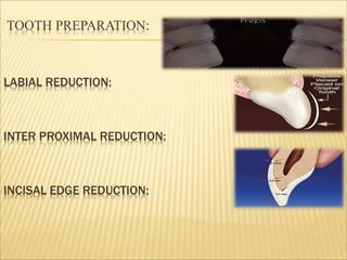 Resin laminate veneers | PPTX