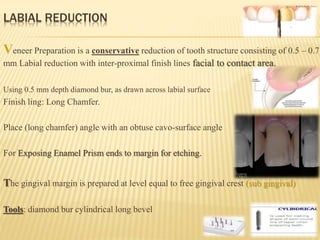 Resin laminate veneers | PPTX