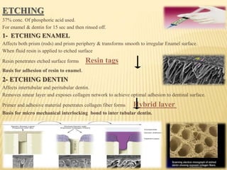Resin laminate veneers | PPTX