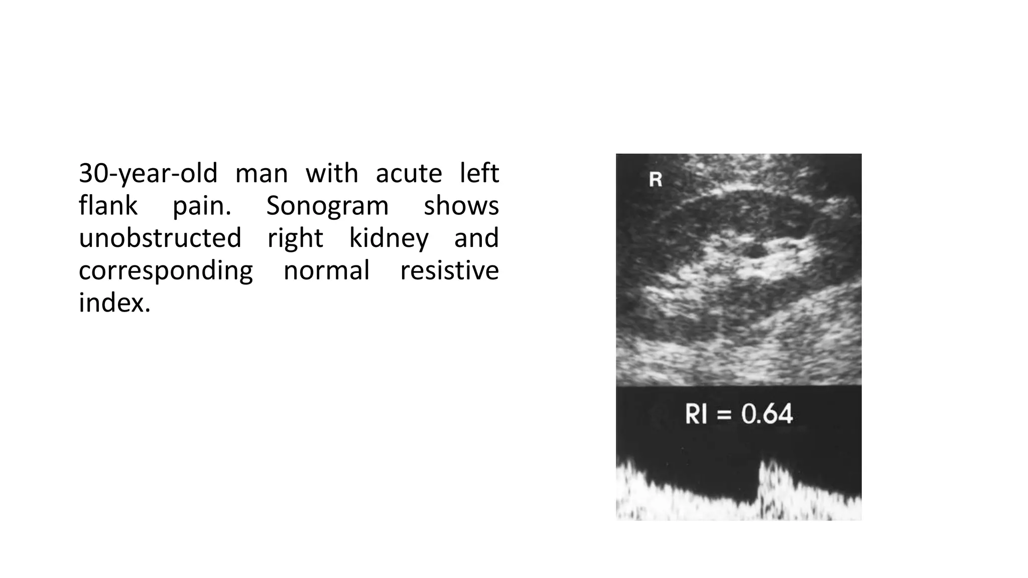 Resistive index and its applications in Urology | PPTX