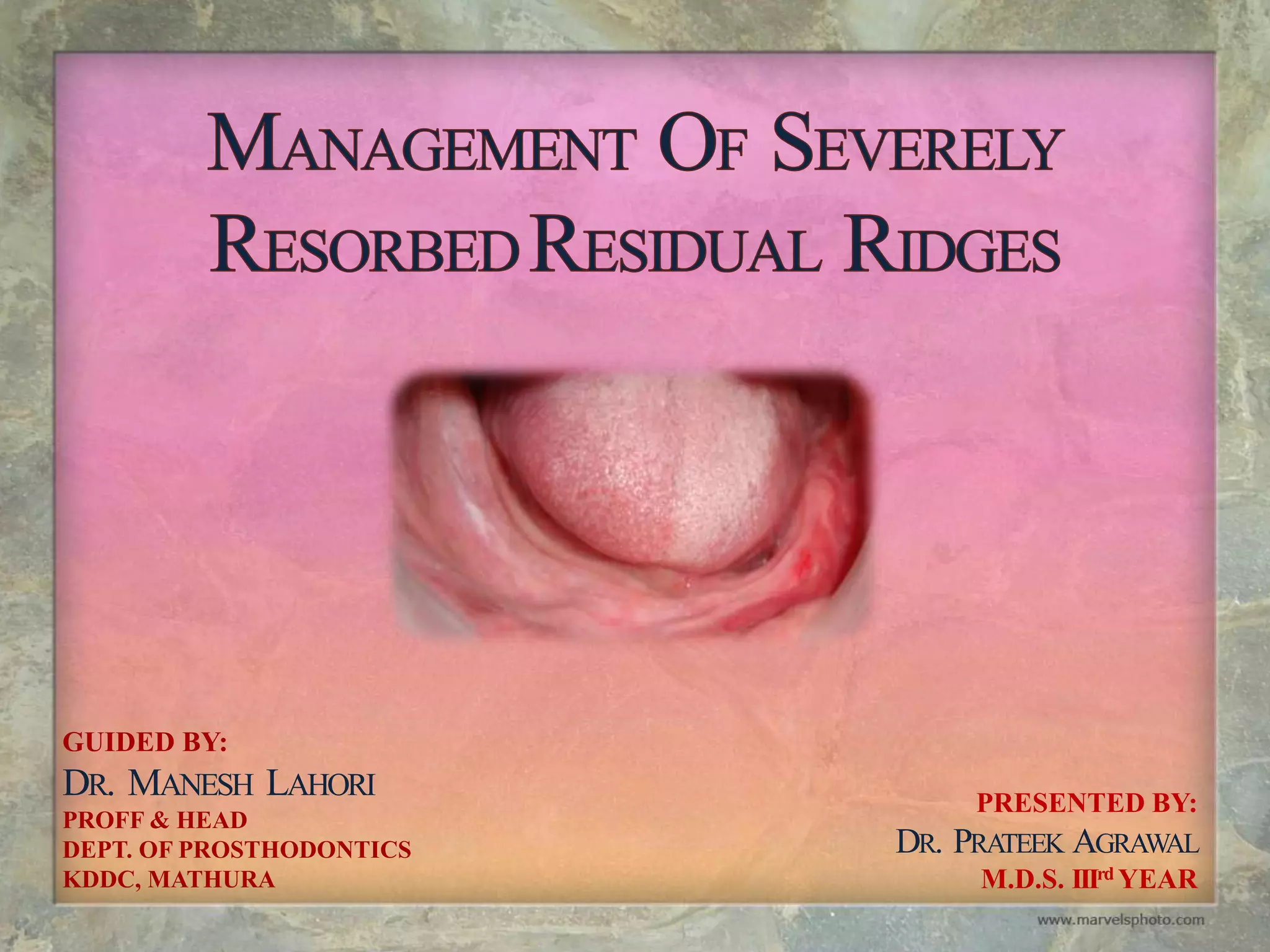 Resorbed ridge seminar koto | PPTX