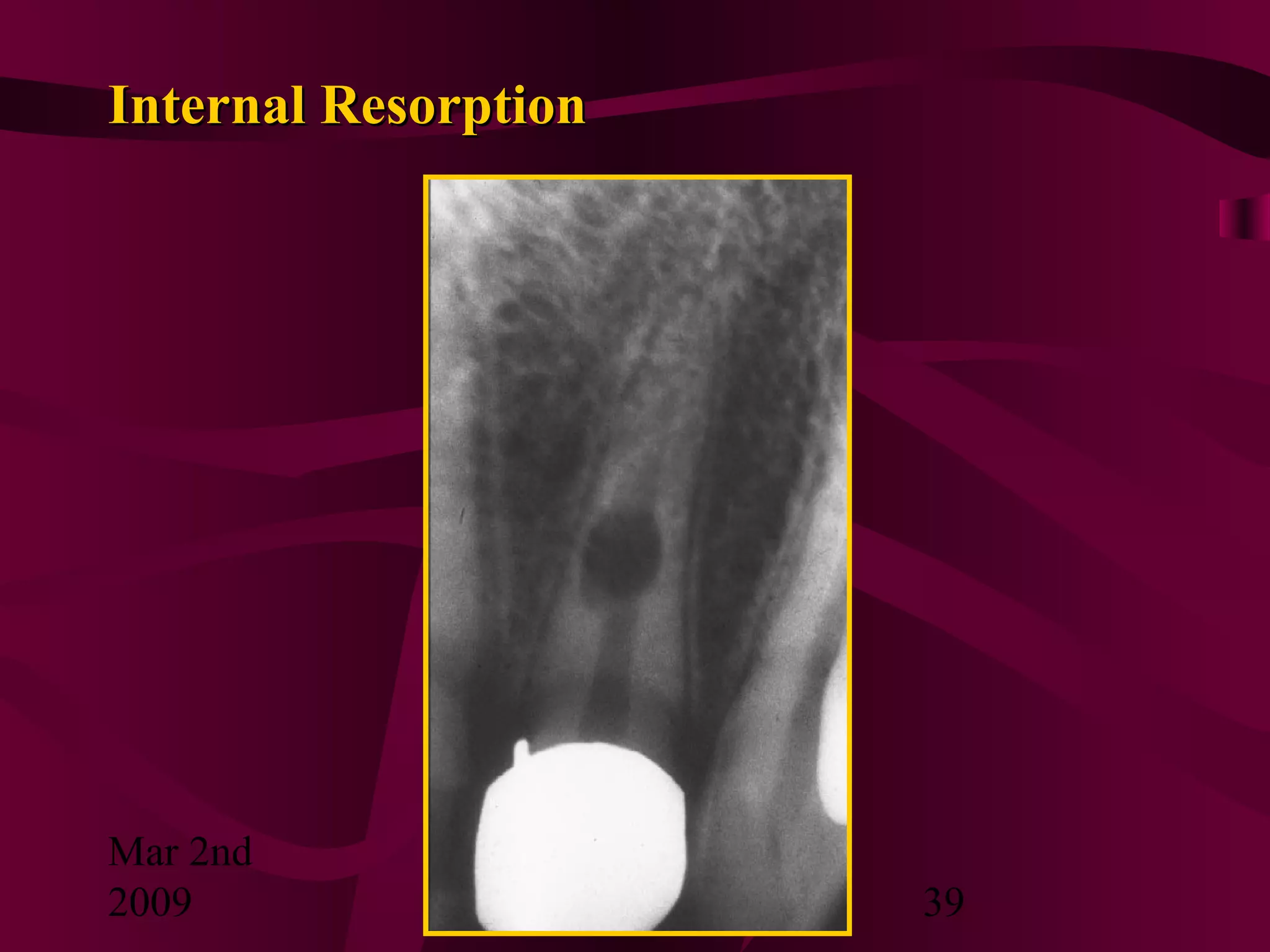 Teeth Resorption | PPT