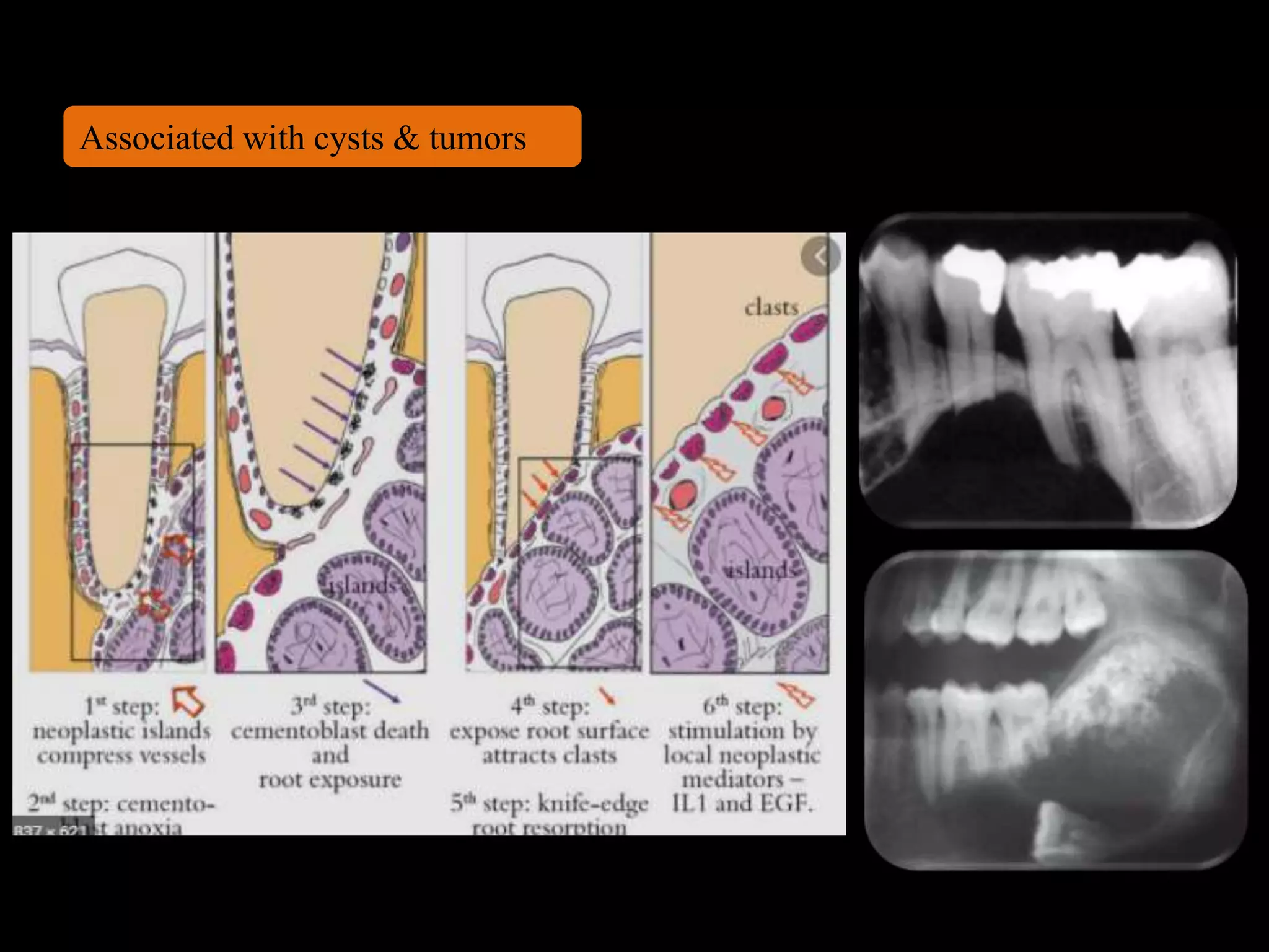 Resorption of teeth | PPTX