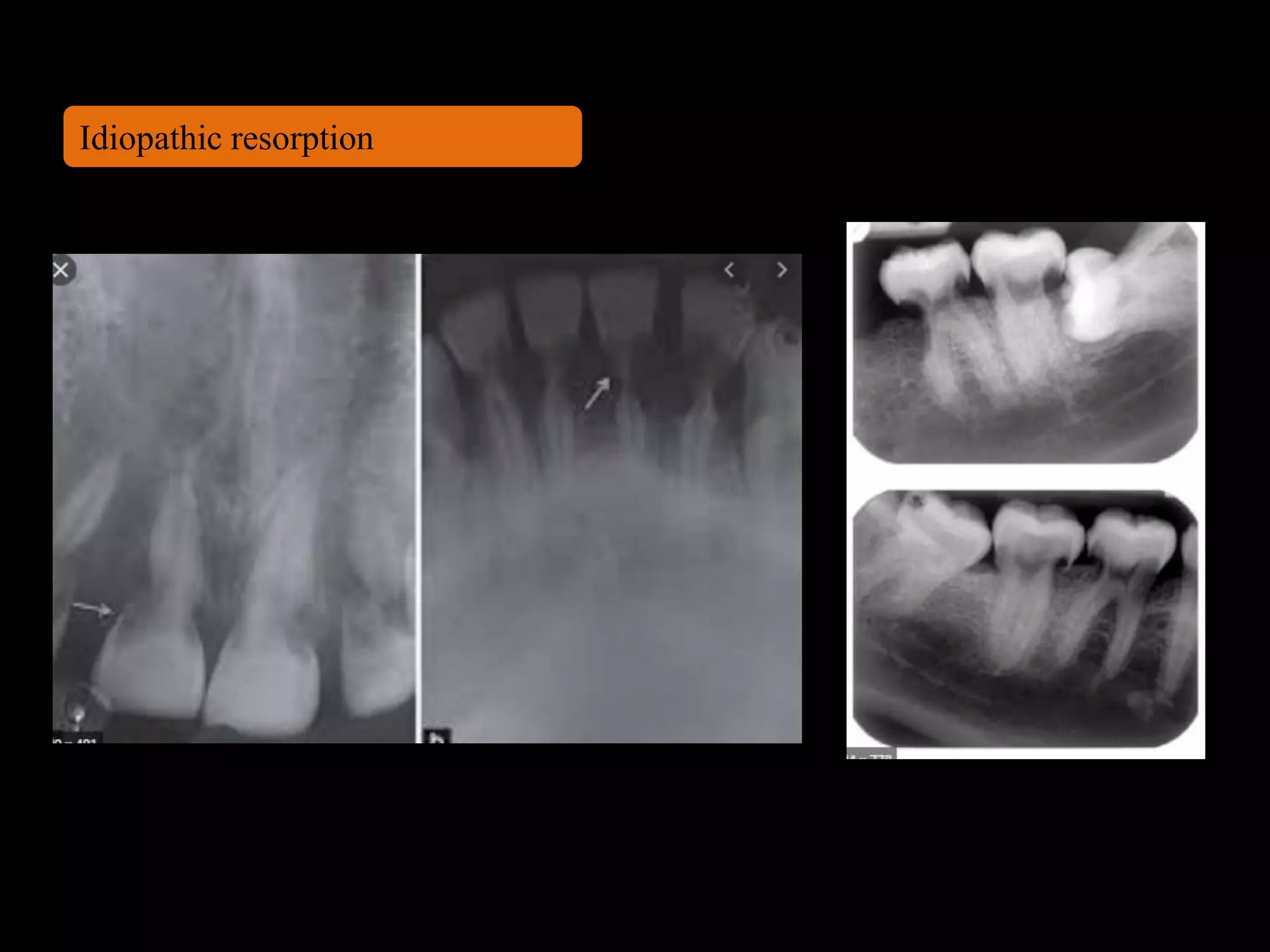 Resorption of teeth | PPTX